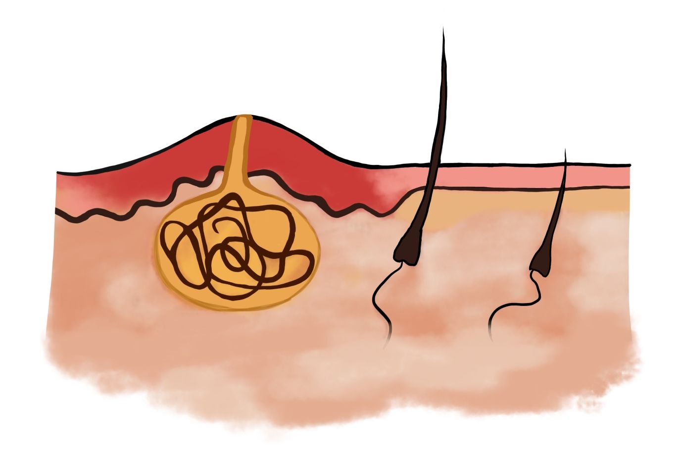What is a pilonidal cyst and how does it develop?